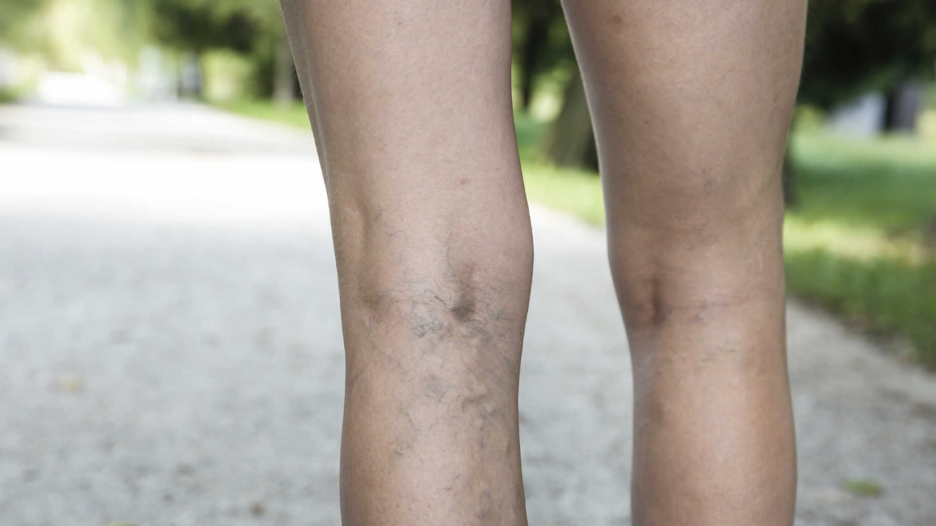 Medcenter - Varizes: causas, tratamentos e prevenção